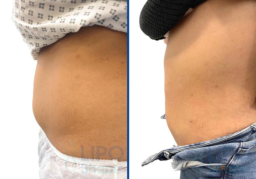 Before and After VASER Liposuction Treatments - LipoShape UK
