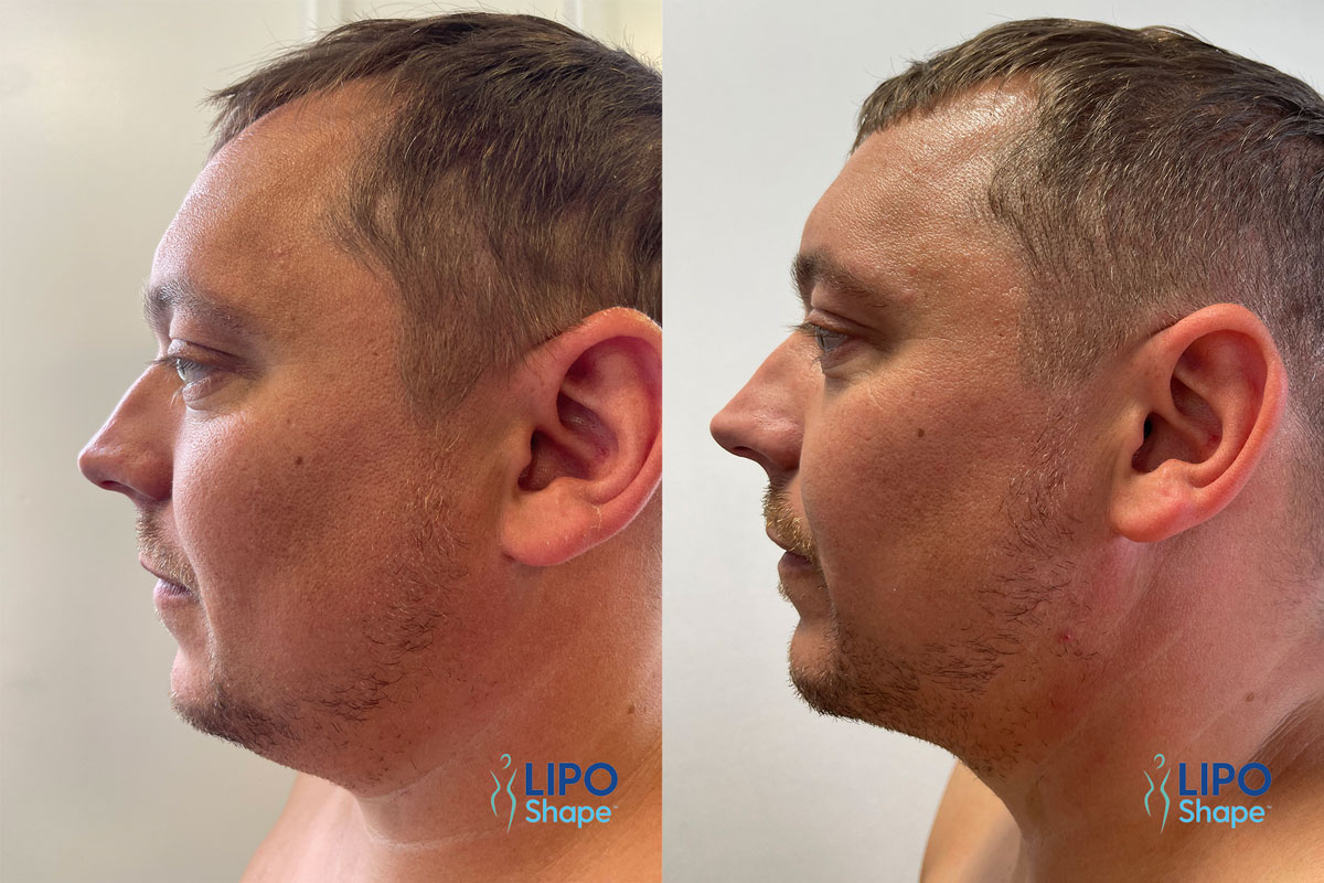 Before and After VASER Liposuction Treatments - LipoShape UK